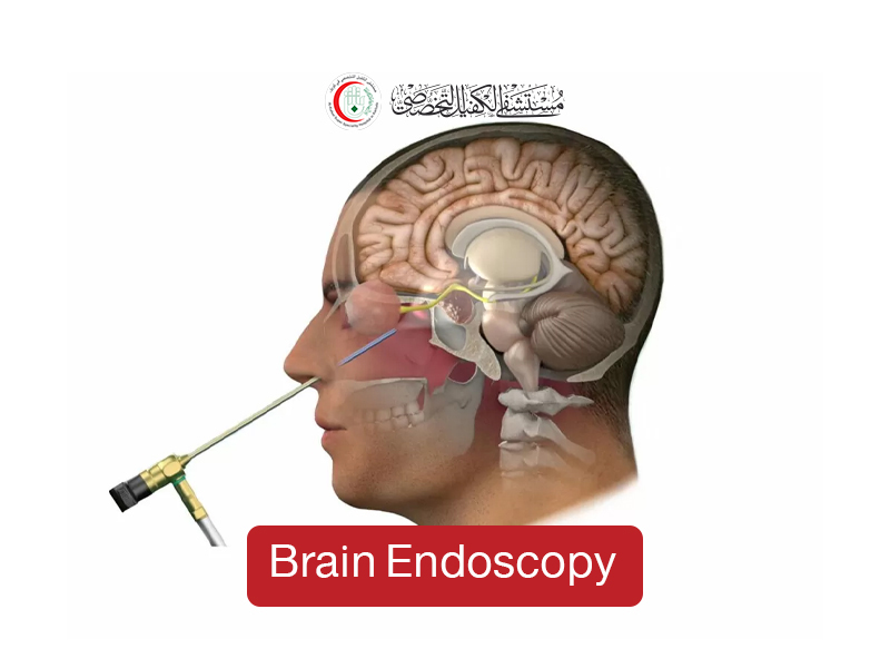 Brain Endoscopy