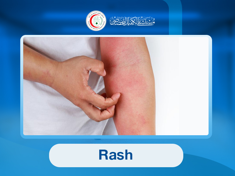 Rash