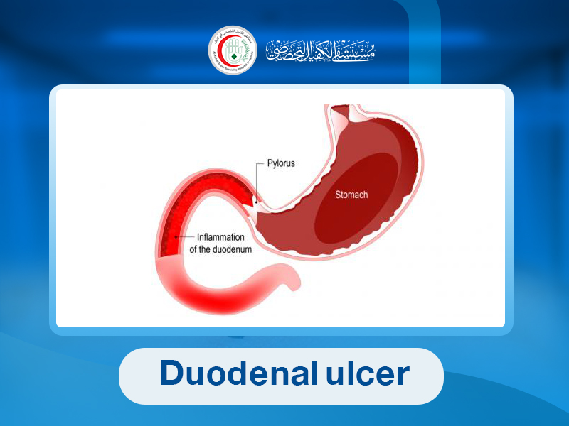Duodenal Ulcer
