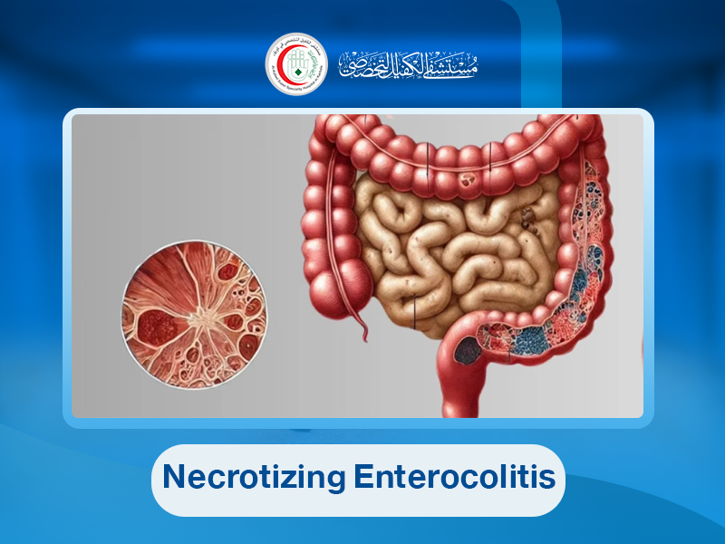 Necrotizing Enterocolitis